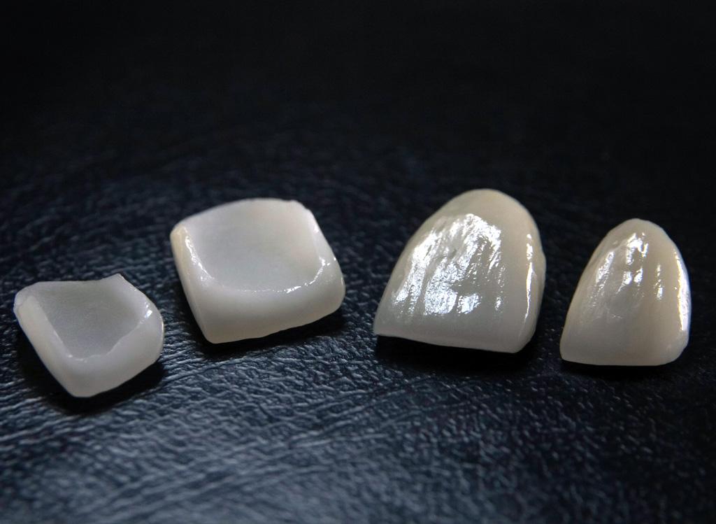 Veneers – Dental laboratory